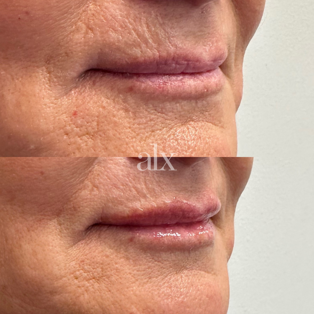 Cosmetic Injections - ALX Medical